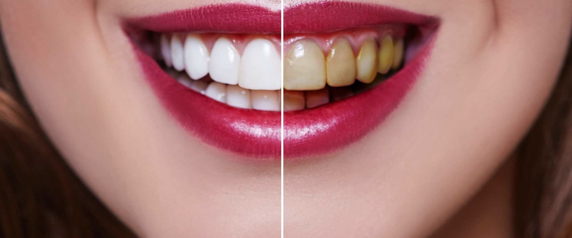 The Evolution Of The Teeth Whitening Best Method